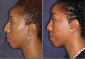 Facial Plastic Surgery Indianapolis | Female Facial Plastic Surgeon