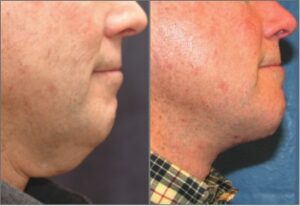 Facial Plastic Surgery Indianapolis | Female Facial Plastic Surgeon