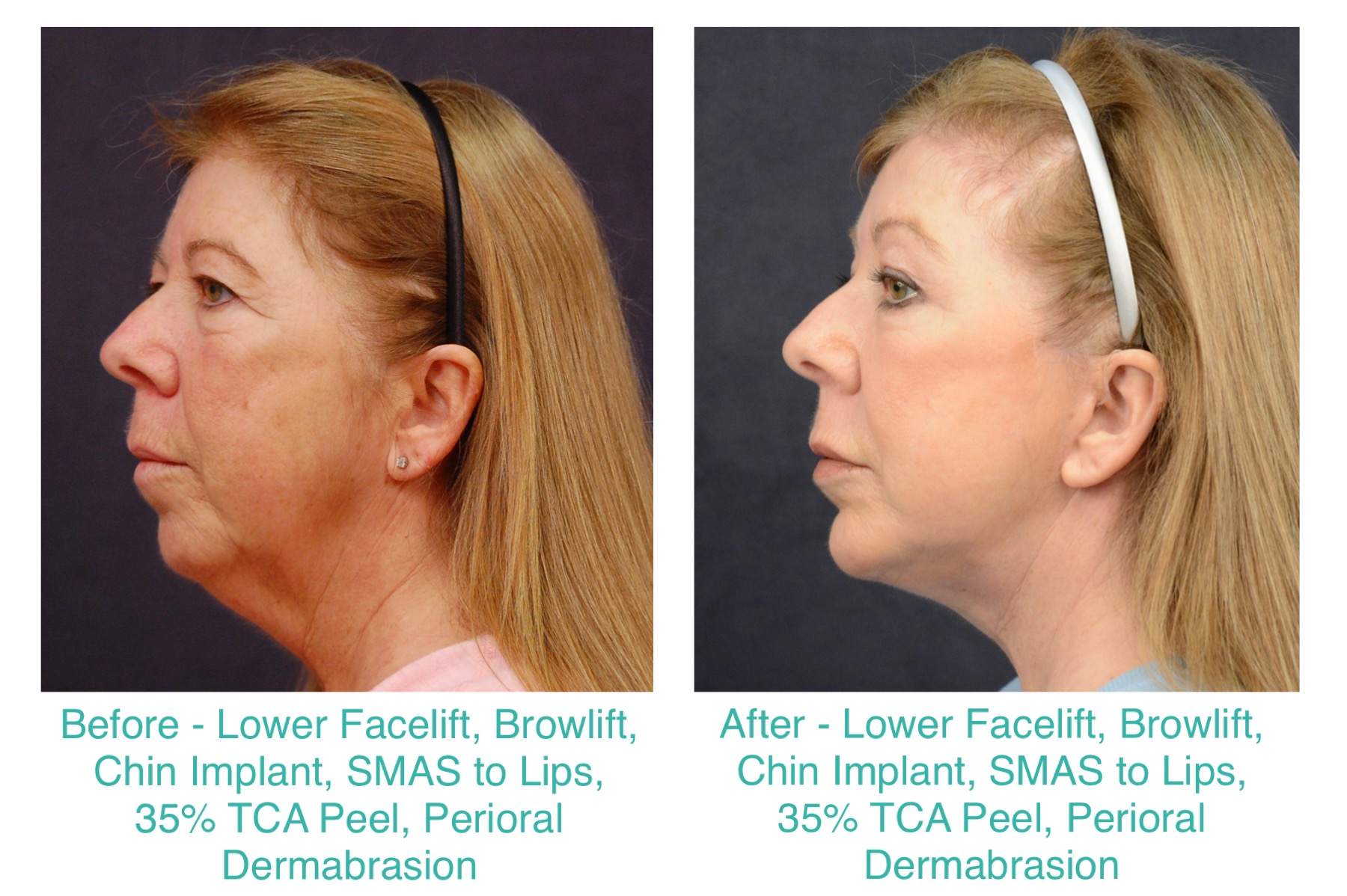 Indianapolis Lower Facelift Before & After Photo Gallery